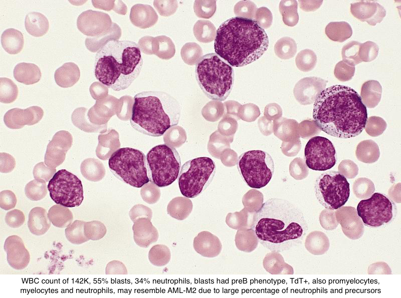 Pathology Outlines - Chronic myeloid leukemia