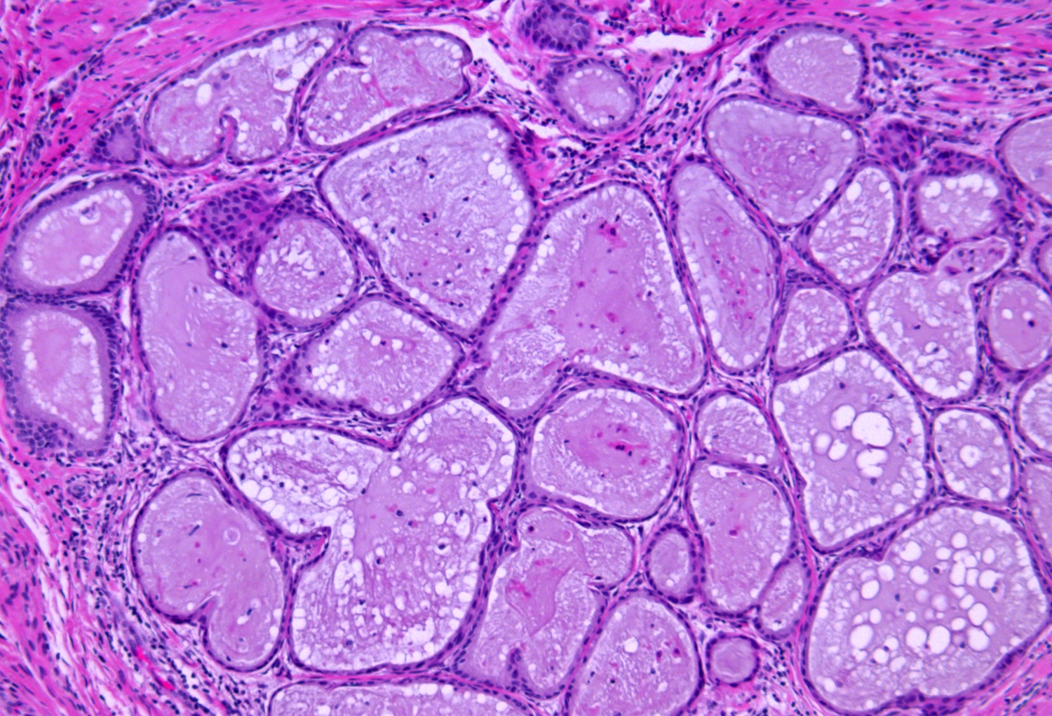 Pathology Outlines Tunnel Clusters