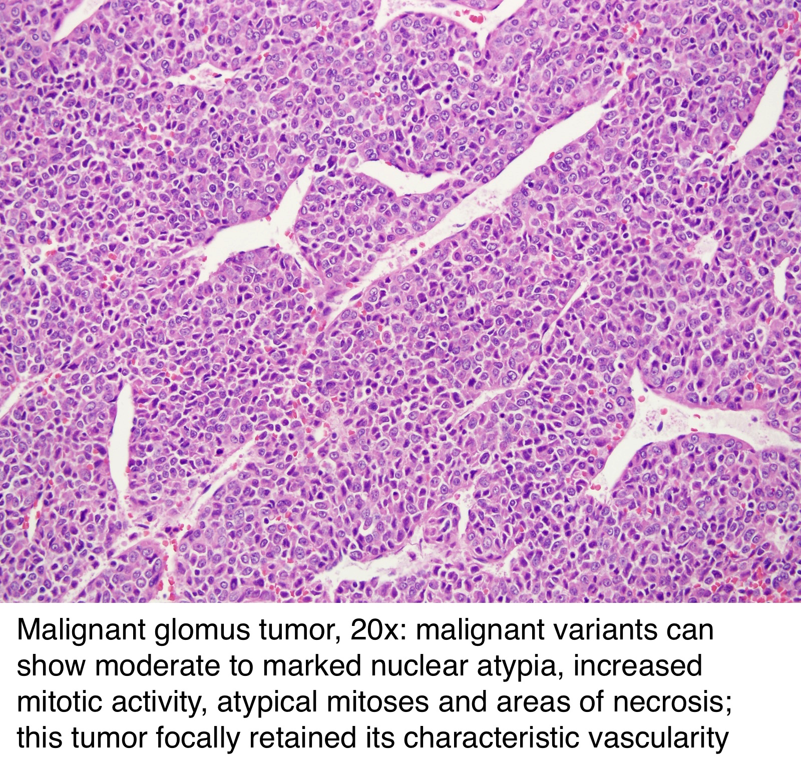 Glomus Tumor