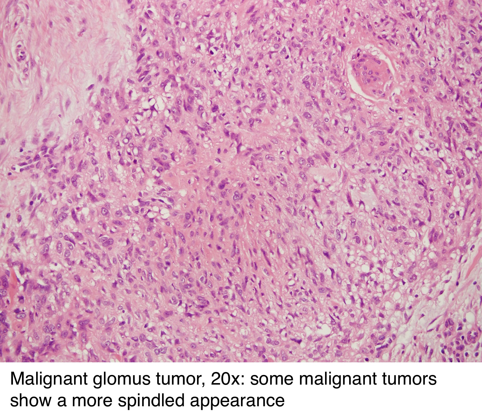 Pathology Outlines - Glomus tumor