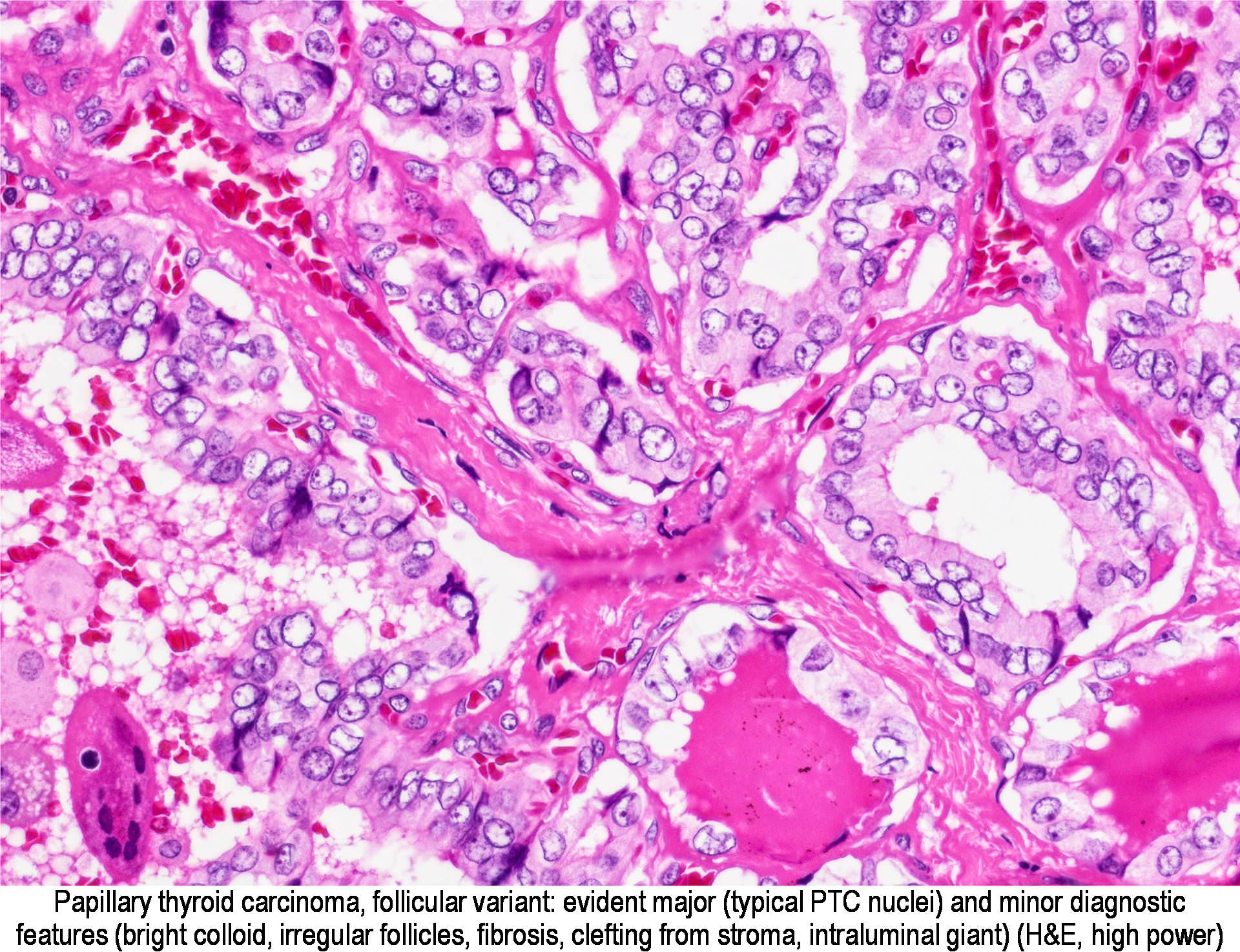 Papillary Thyroid Cancer