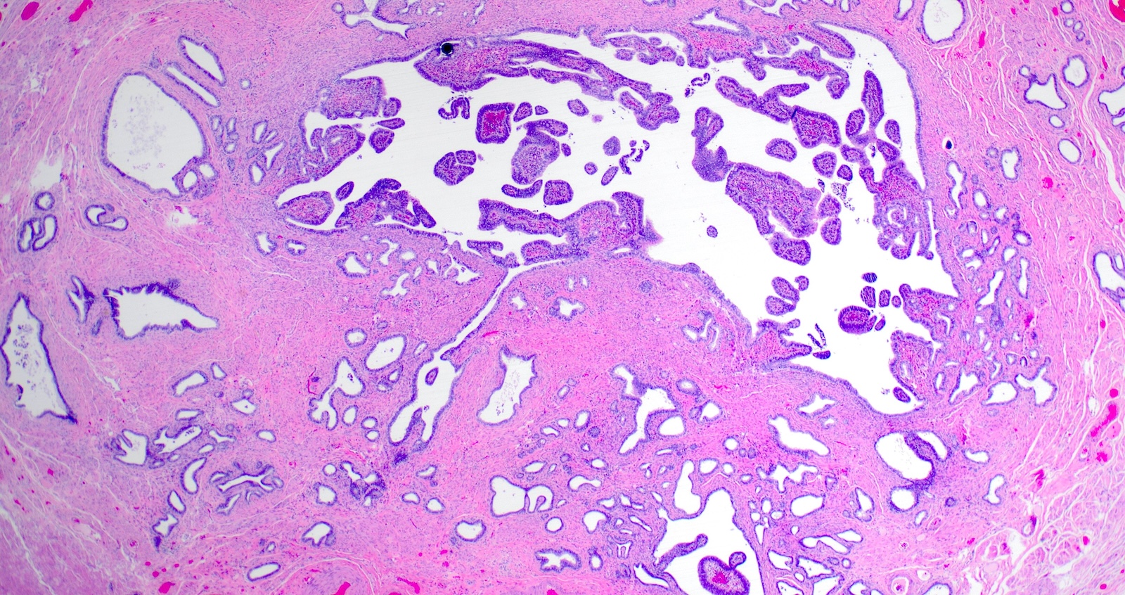 Pathology Outlines - Salpingitis isthmica nodosa
