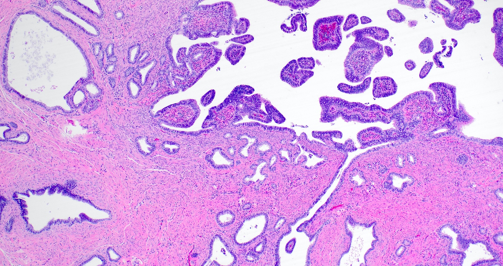 Pathology Outlines - Salpingitis isthmica nodosa