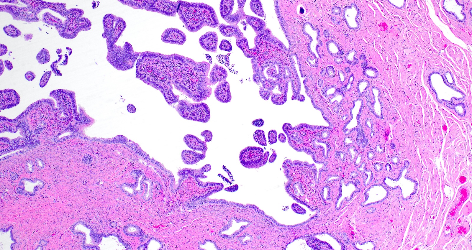 Pathology Outlines - Salpingitis isthmica nodosa
