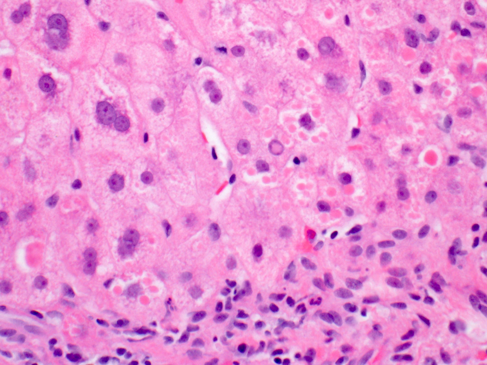 Pathology Outlines - Case of the Month #554
