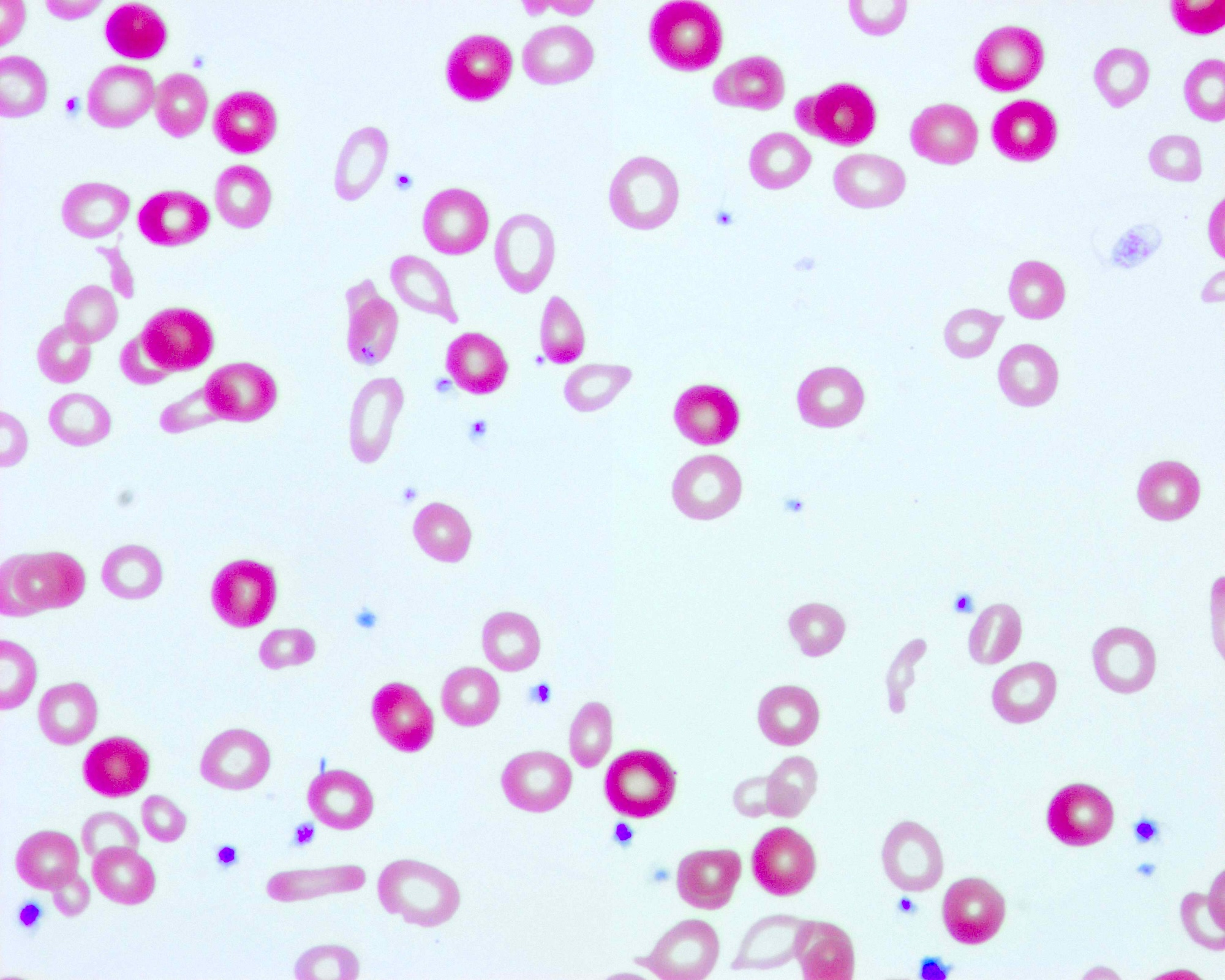Pathology Outlines - Iron deficiency anemia