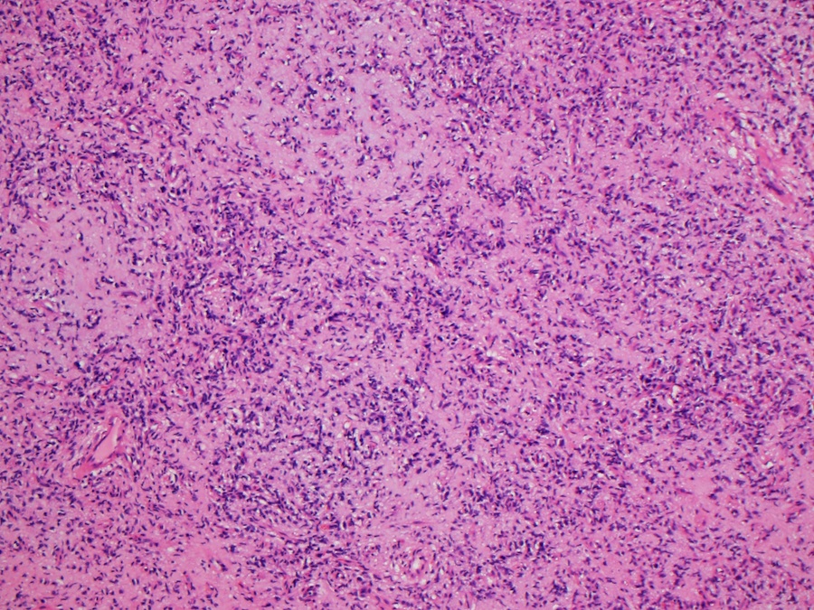 Pathology Outlines - Angiofibroma of soft tissue