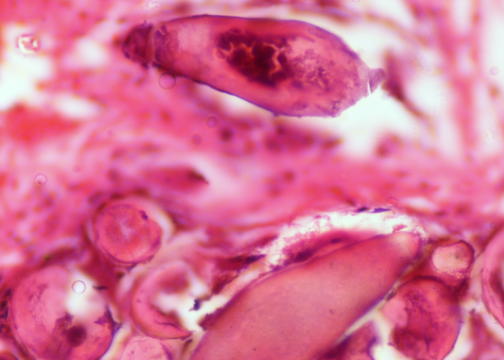 Pathology Outlines - Schistosomiasis