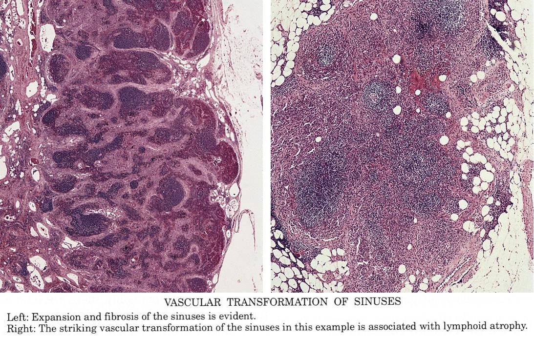 Pathology Outlines - Vascular transformation of sinuses