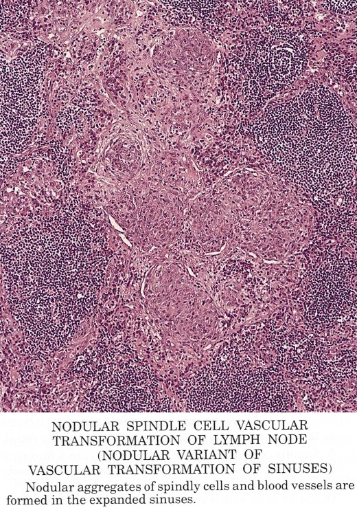 Pathology Outlines - Vascular transformation of sinuses