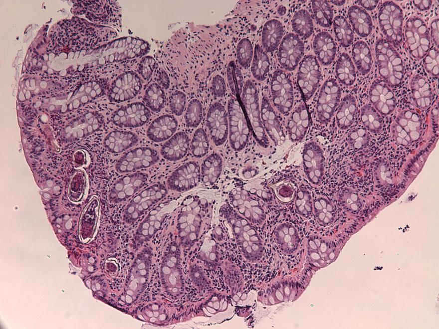 Pathology Outlines - Schistosomiasis