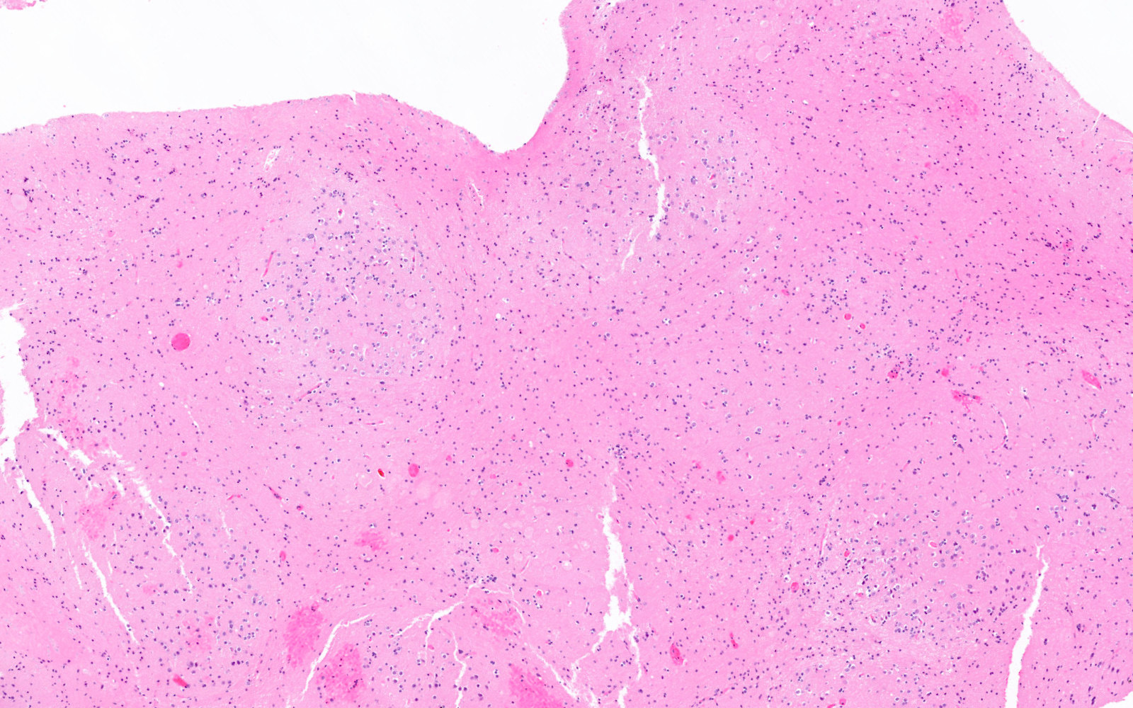 Pathology Outlines - Multinodular and vacuolating neuronal tumor (MVNT)