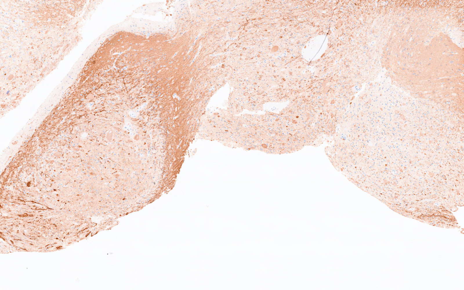 Pathology Outlines - Multinodular and vacuolating neuronal tumor (MVNT)
