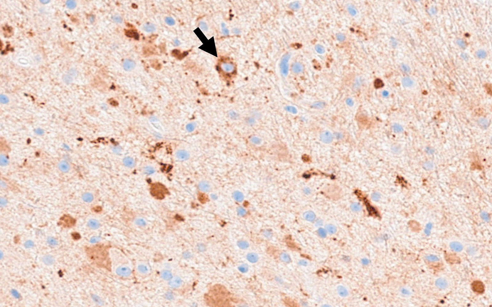 Pathology Outlines - Multinodular and vacuolating neuronal tumor (MVNT)
