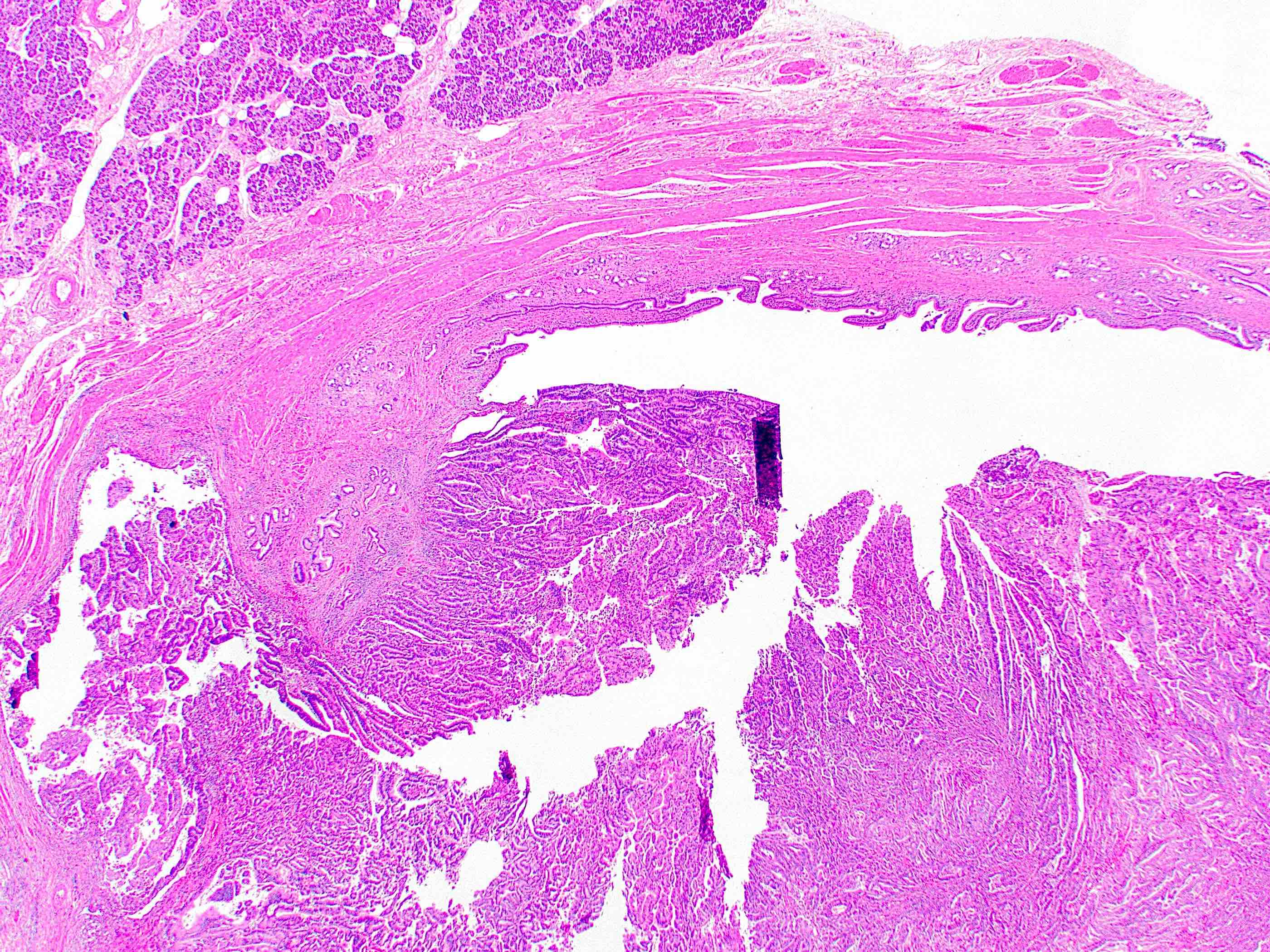 Pathology Outlines - Carcinoma of extrahepatic bile ducts