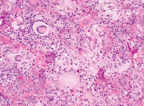 Pathology Outlines - Keratin positive giant cell tumor ...