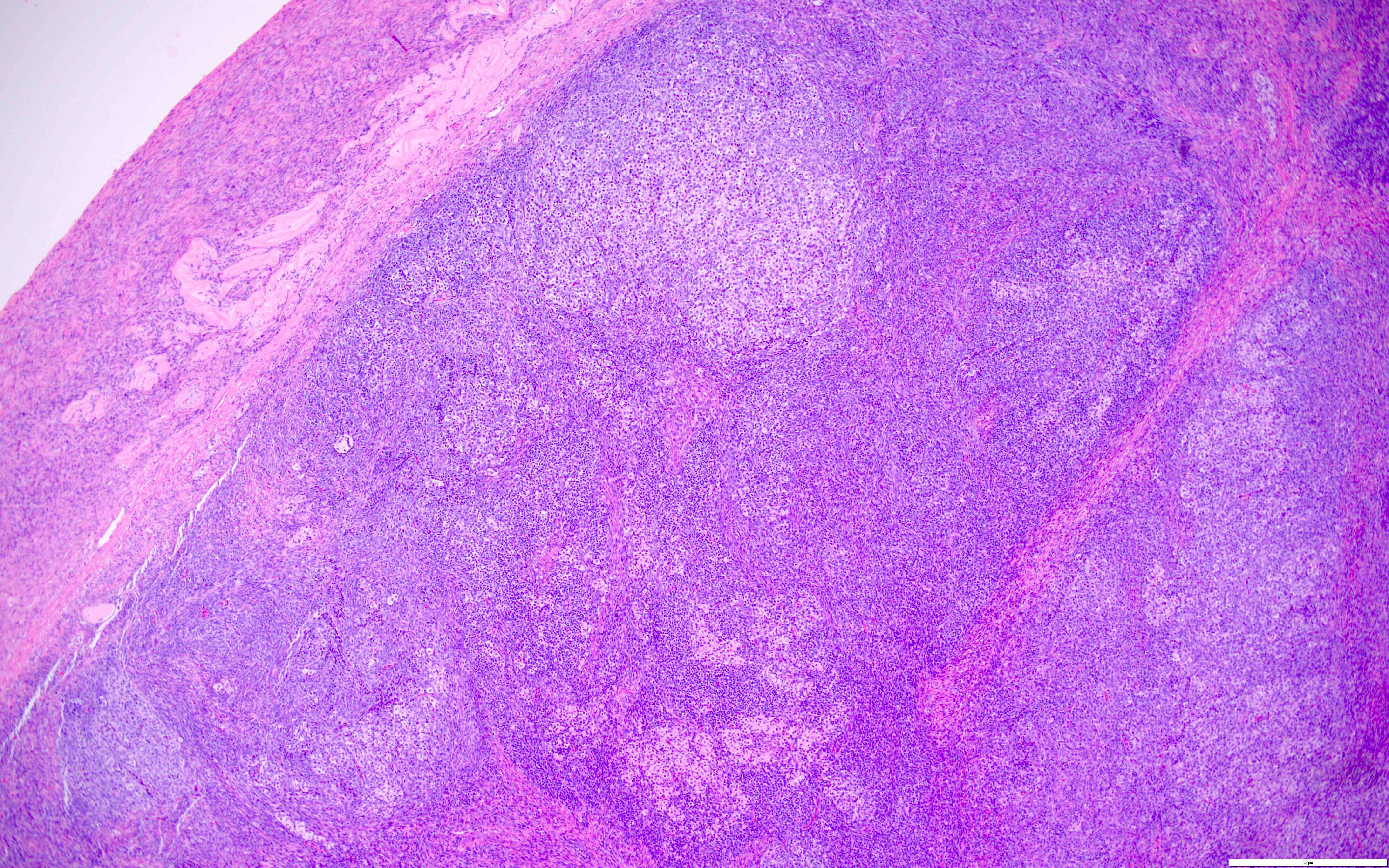 Pathology Outlines - Luteinized thecoma associated with sclerosing ...