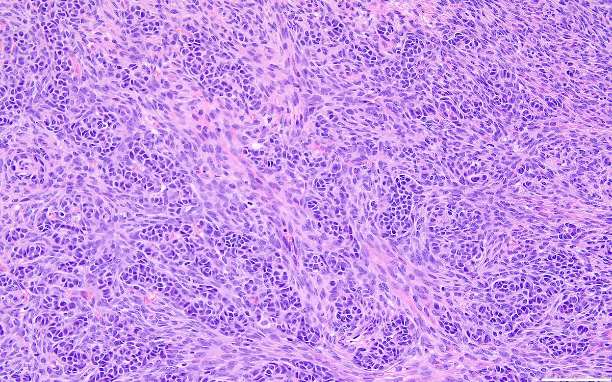 Pathology Outlines - Luteinized thecoma associated with sclerosing ...
