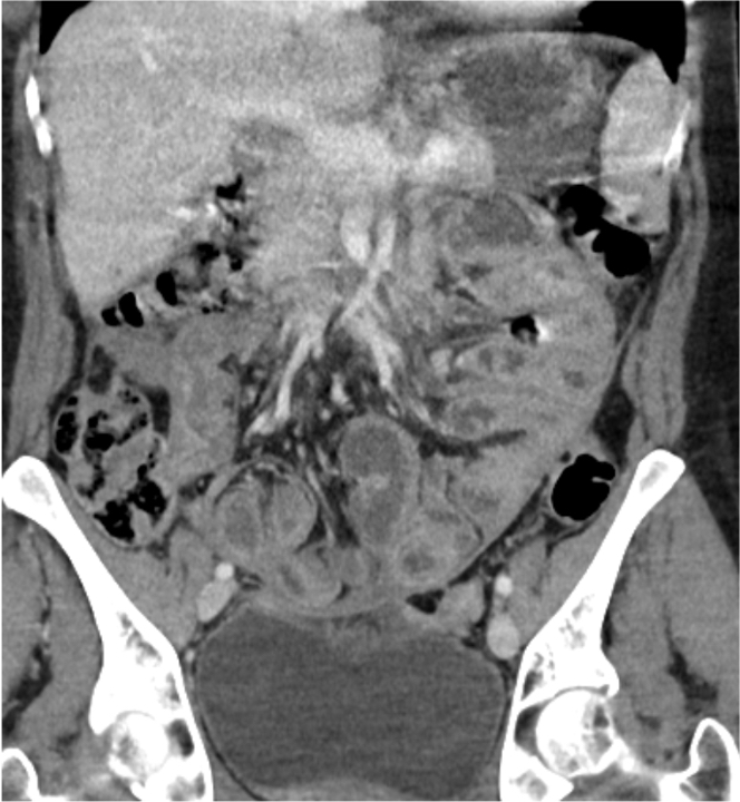 Pathology Outlines - Luteinized thecoma associated with sclerosing ...