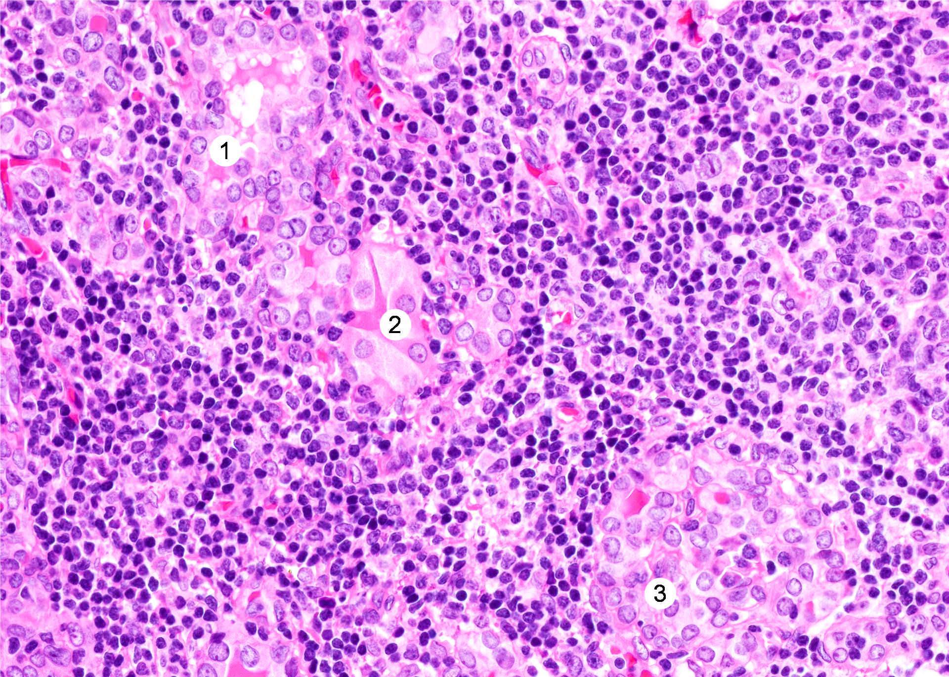 Hashimotos Thyroiditis Histology