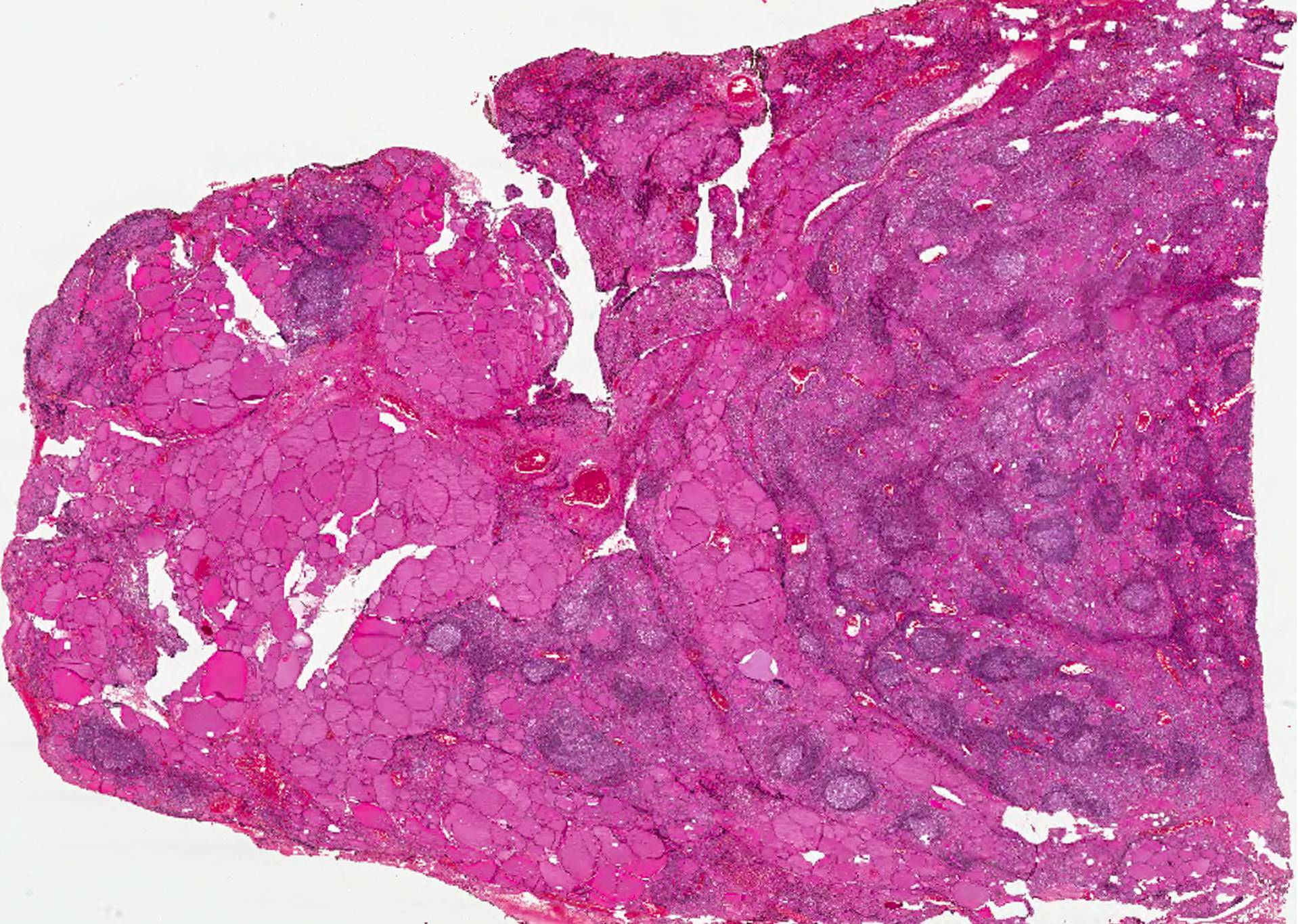 Pathology Outlines - Hashimoto thyroiditis