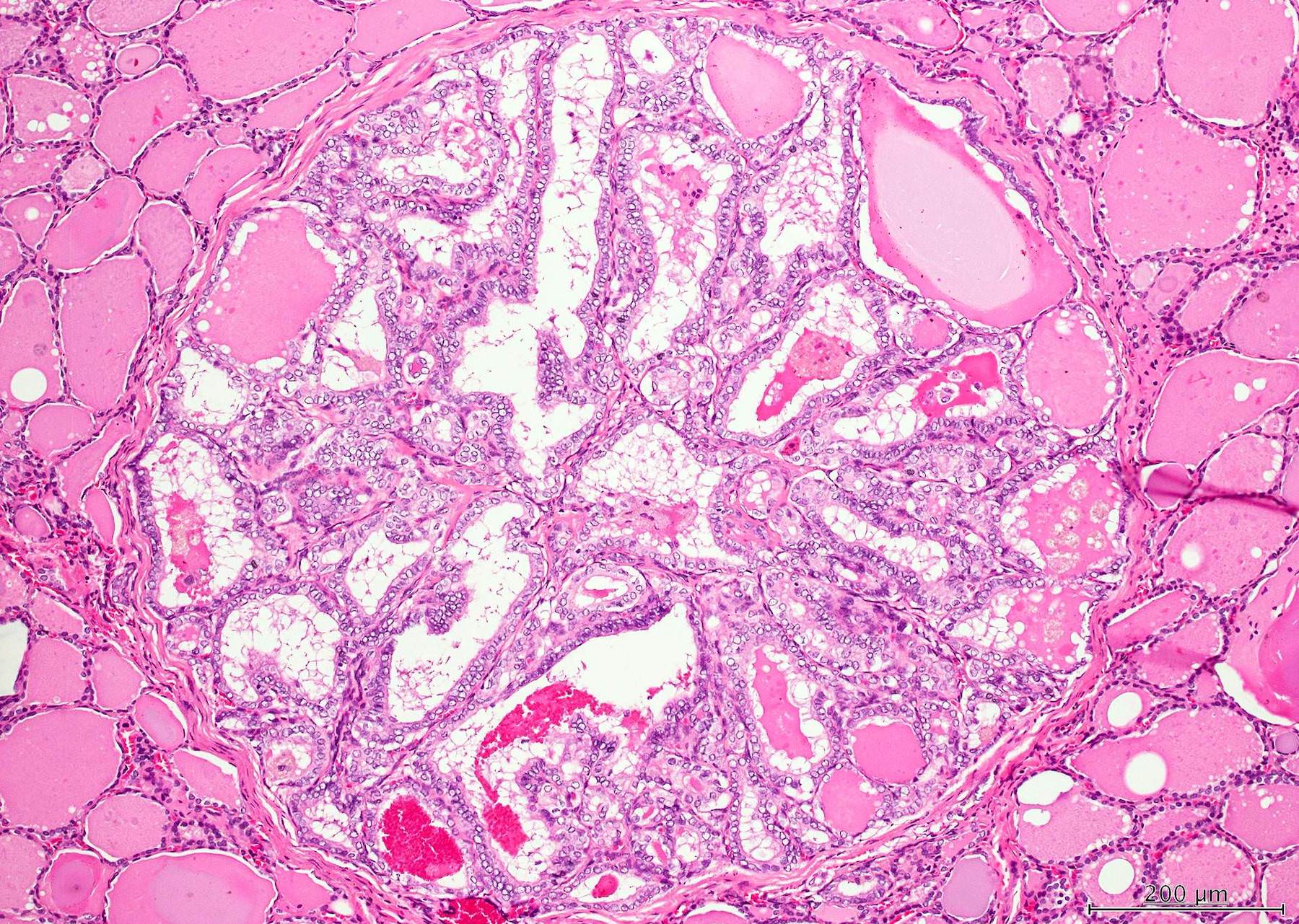 Pathology Outlines - Microcarcinoma