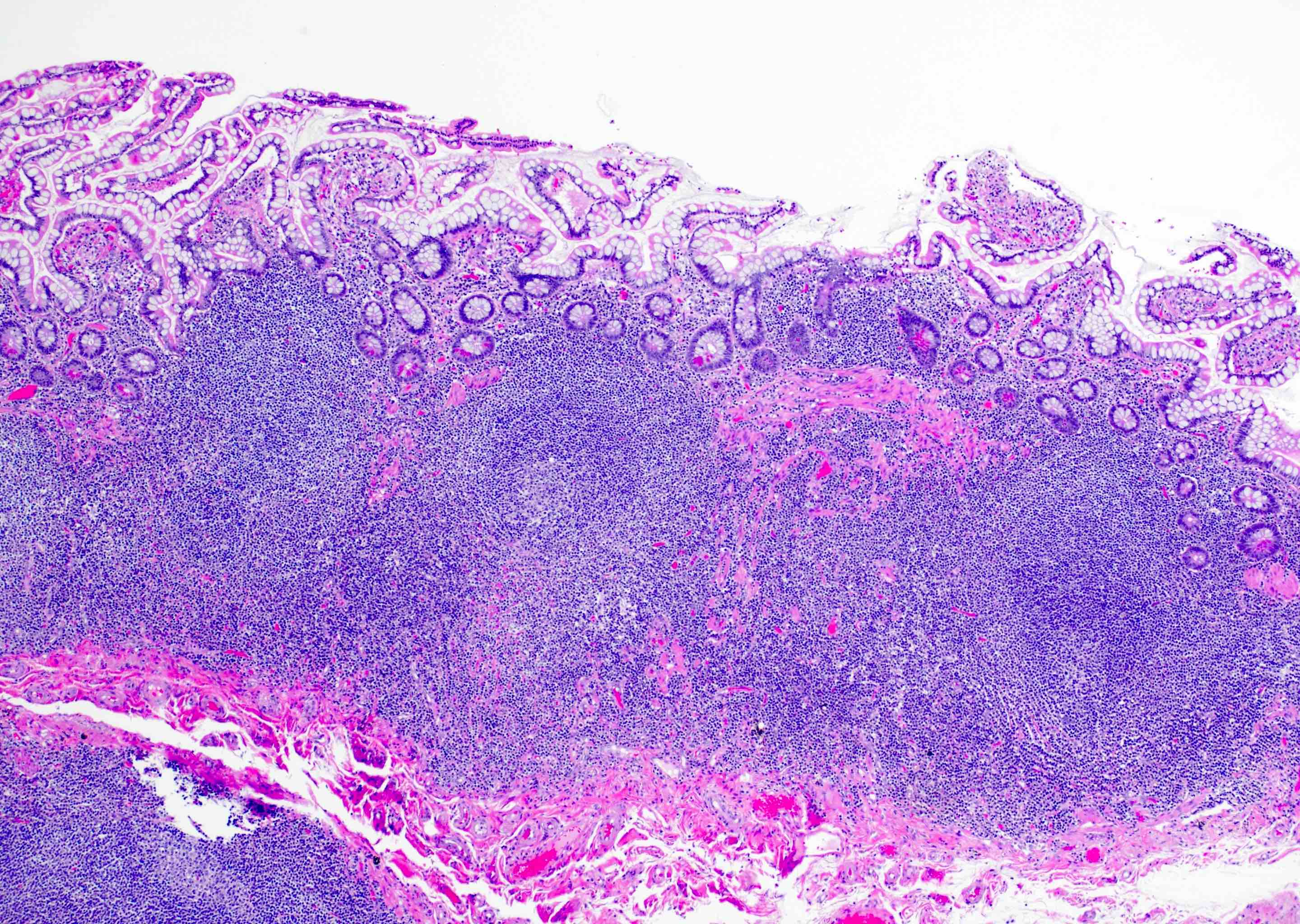 Hyperplastic Polyp Pathology Outlines Clinical Pathology: Intestinal
