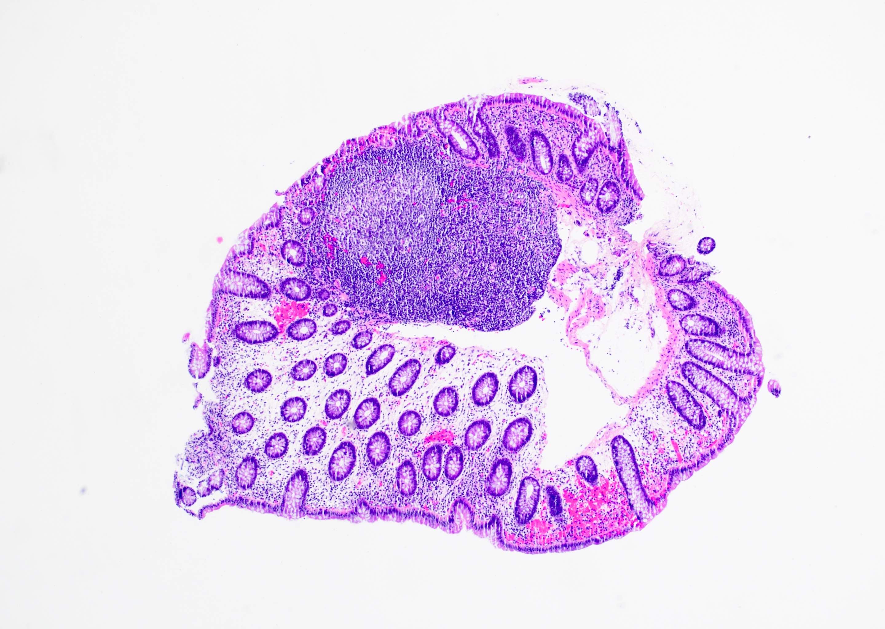 Pathology Outlines - Lymphoid polyp