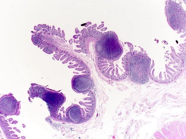 Pathology Outlines - Lymphoid polyp