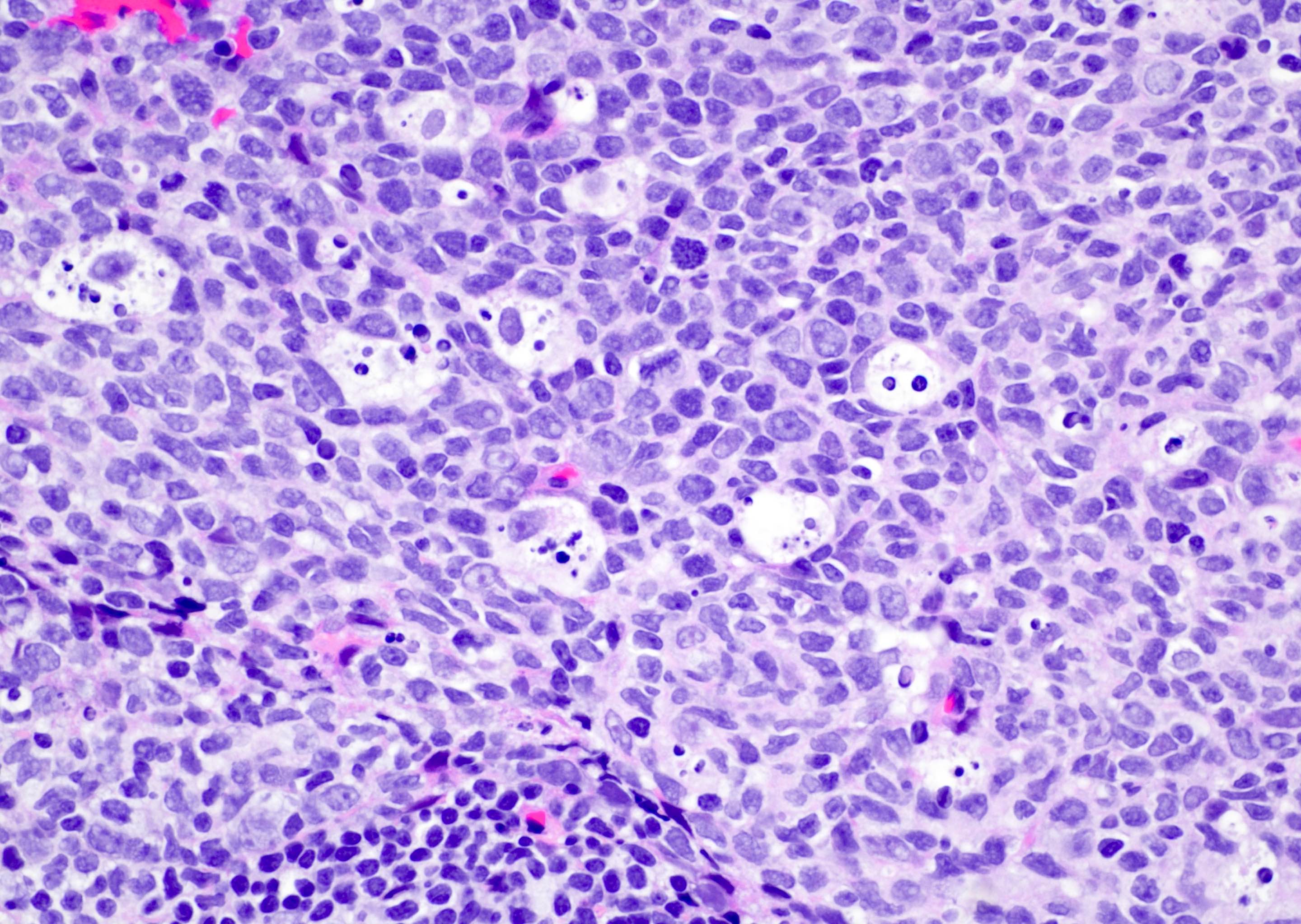 Pathology Outlines - Lymphoid polyp