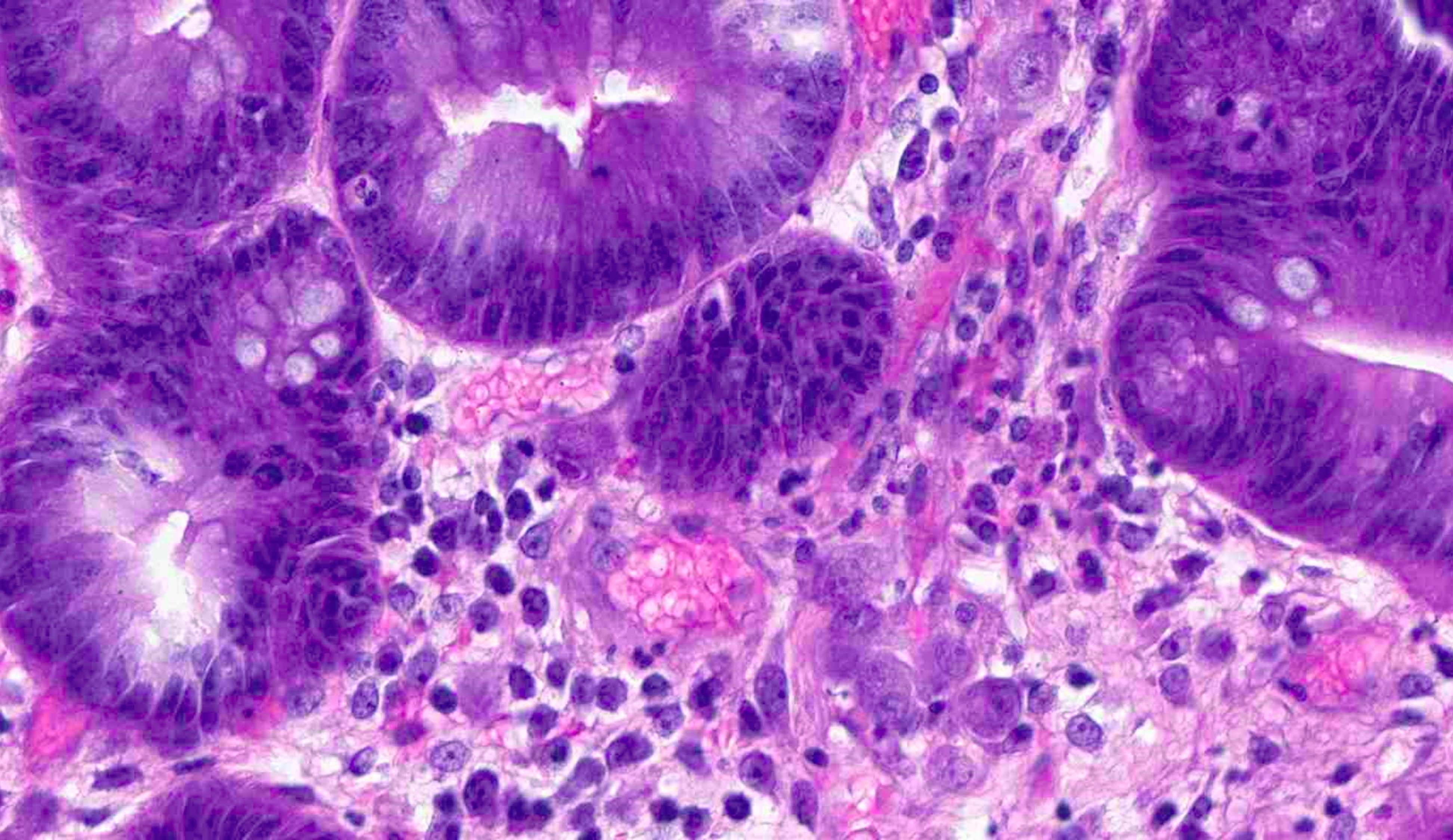 Pathology Outlines - CMV appendicitis