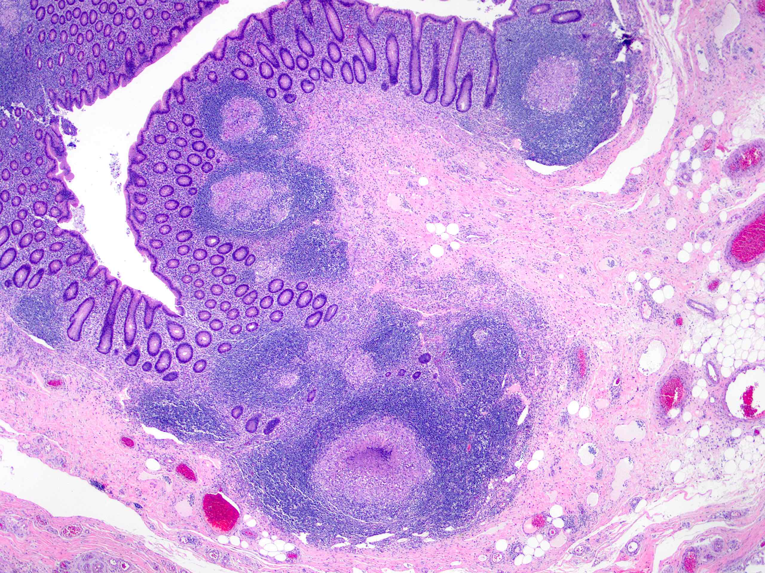 Pathology Outlines - Granulomatous appendicitis