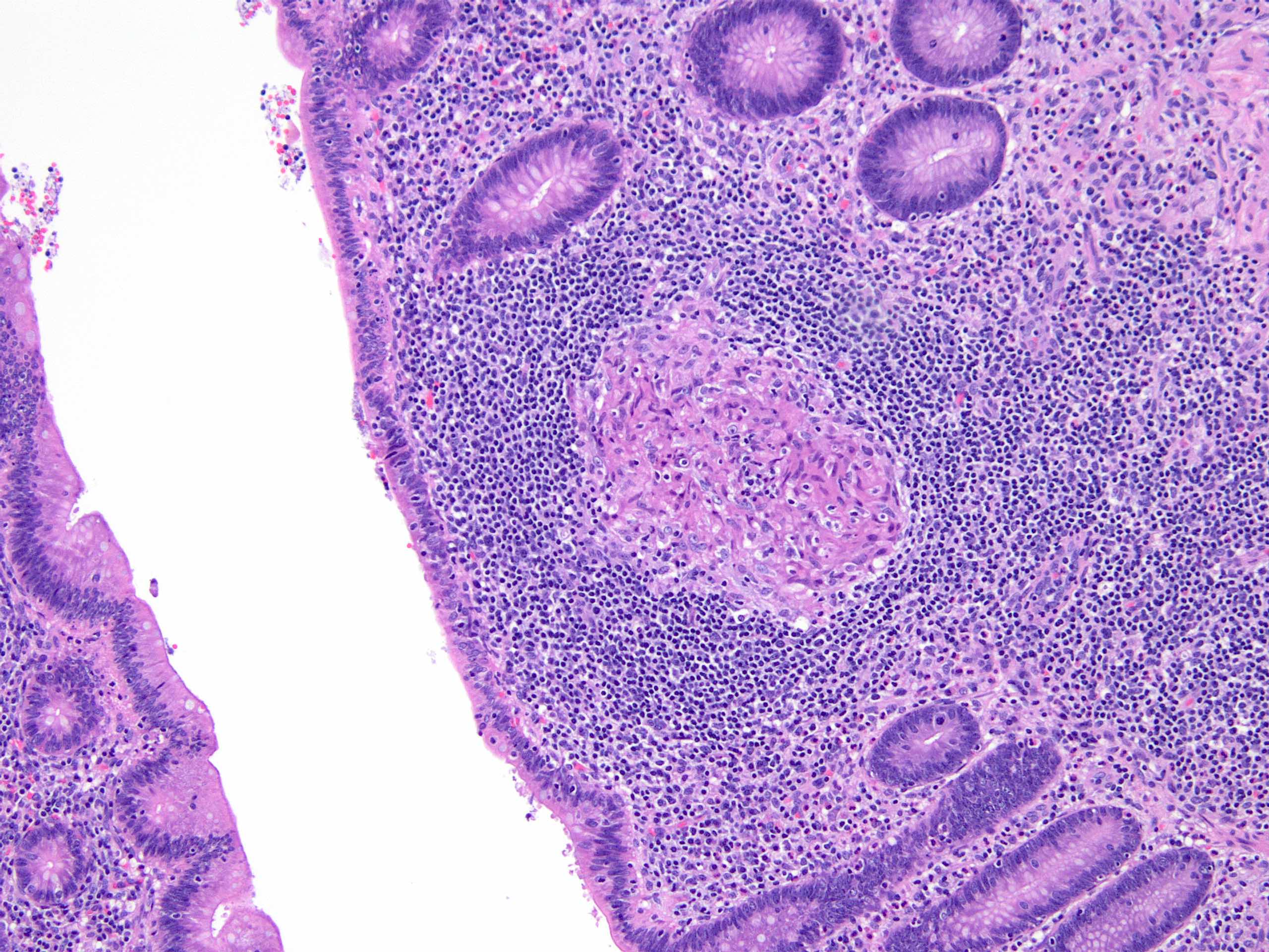Pathology Outlines - Granulomatous appendicitis