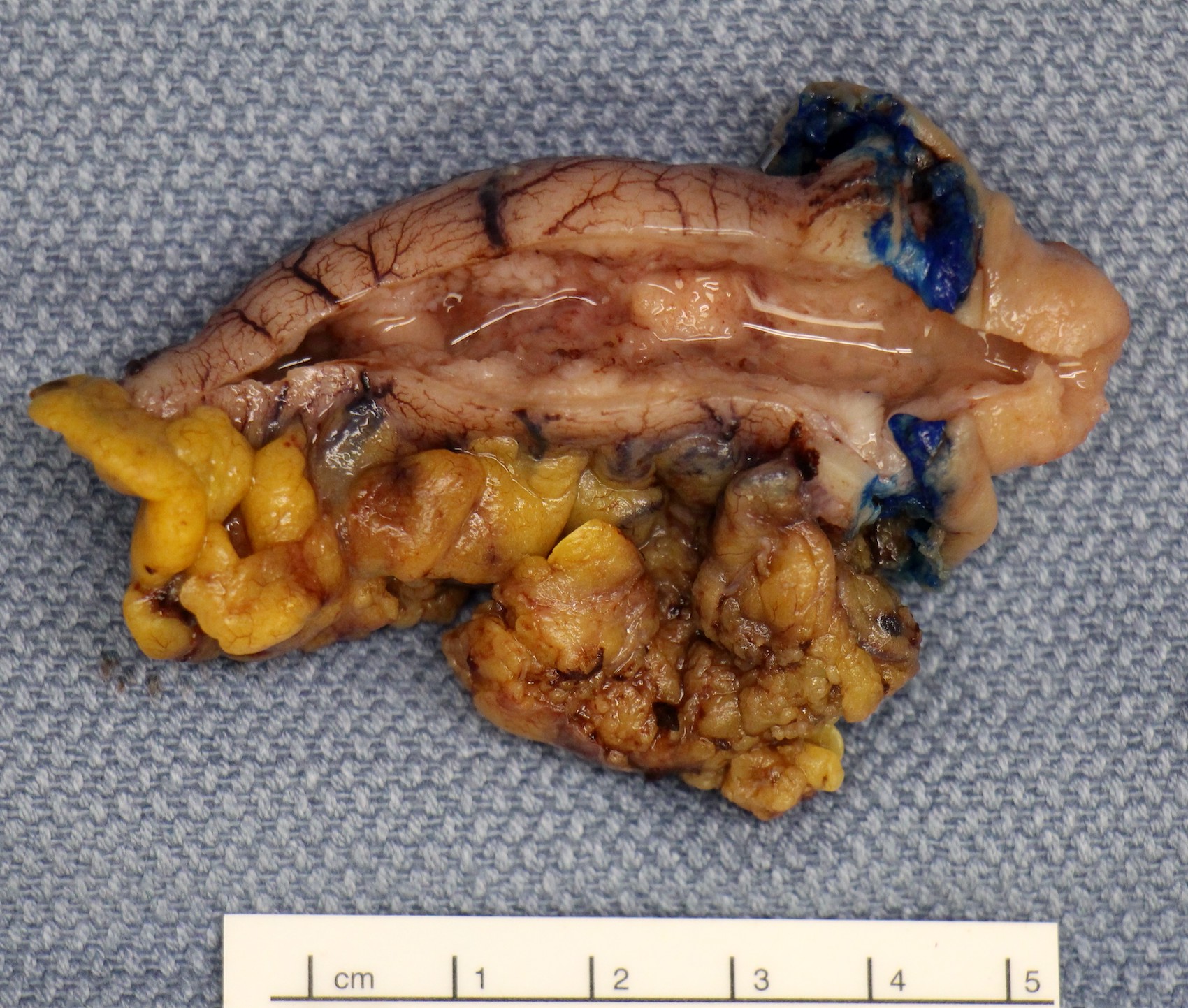 Pathology Outlines - Inverted appendix
