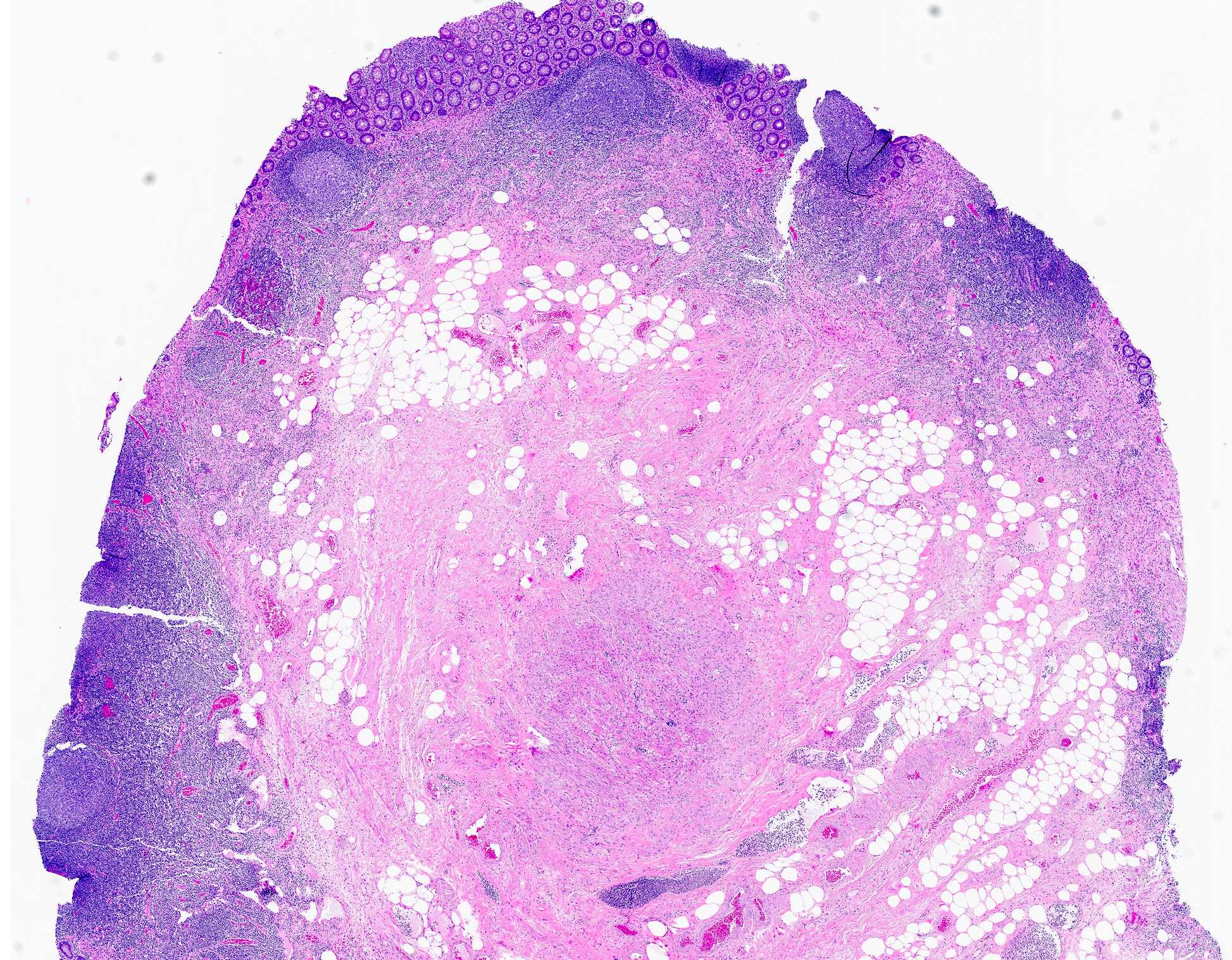 Pathology Outlines - Inverted appendix