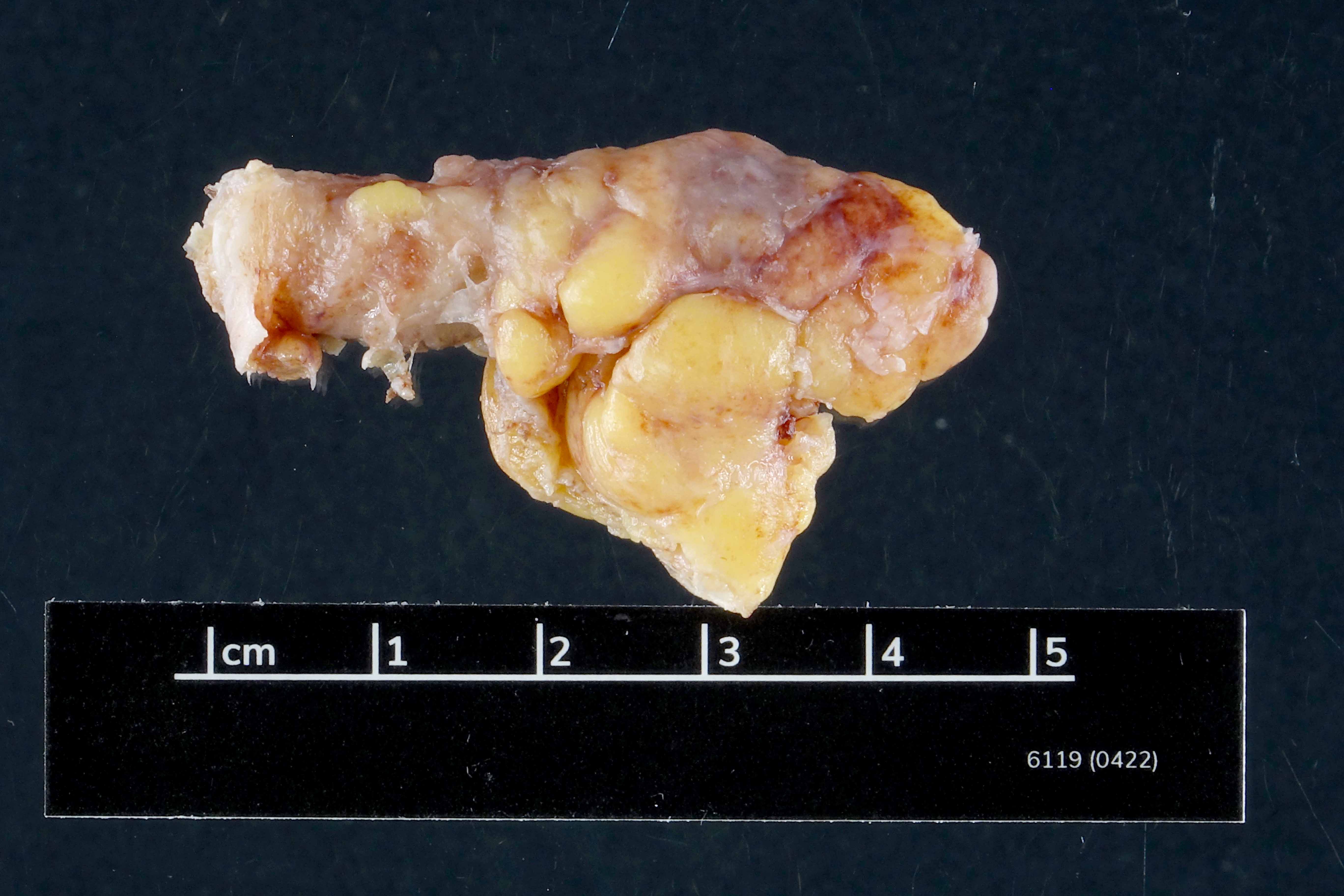 Pathology Outlines - Lymphoid hyperplasia