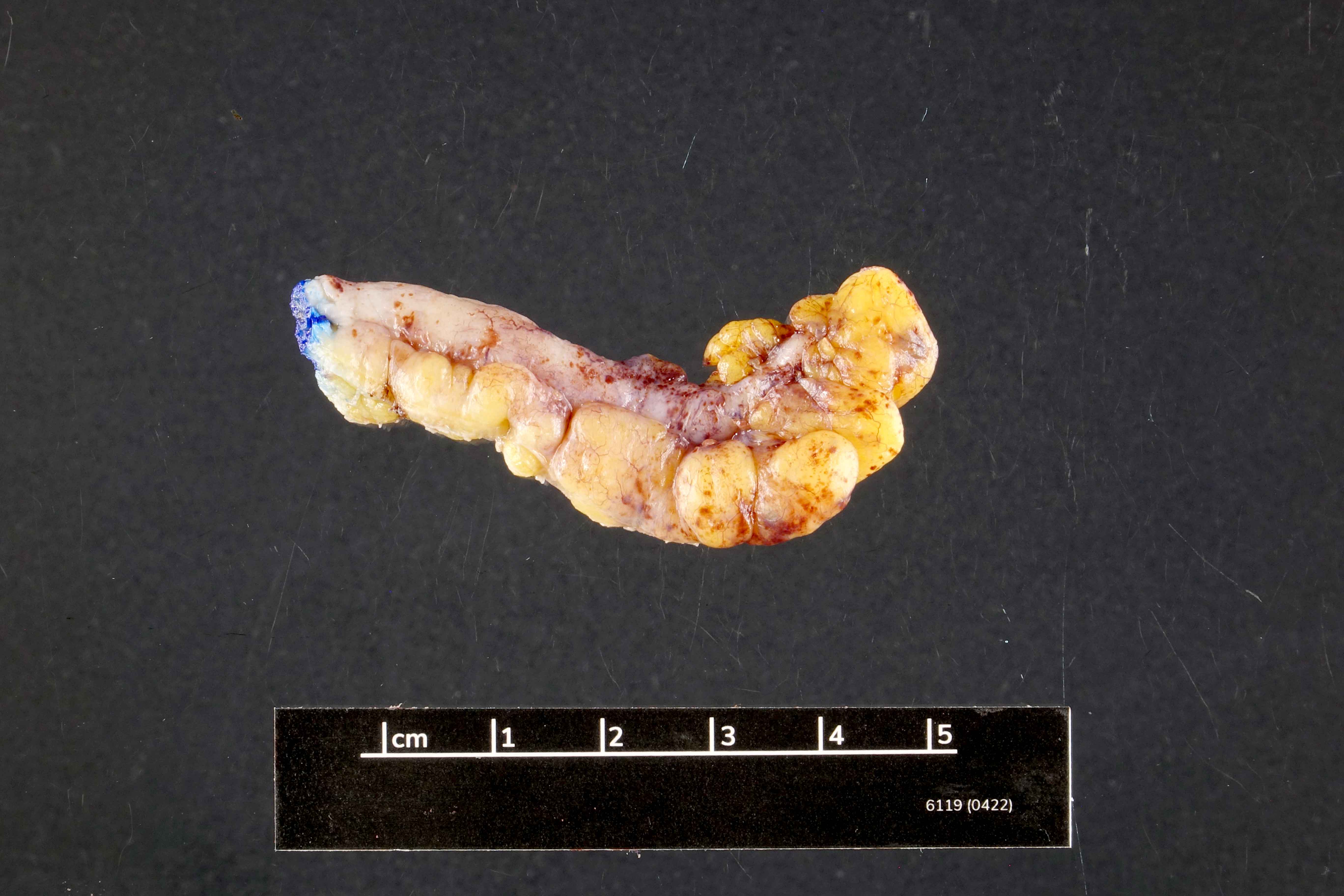Pathology Outlines - Lymphoid hyperplasia
