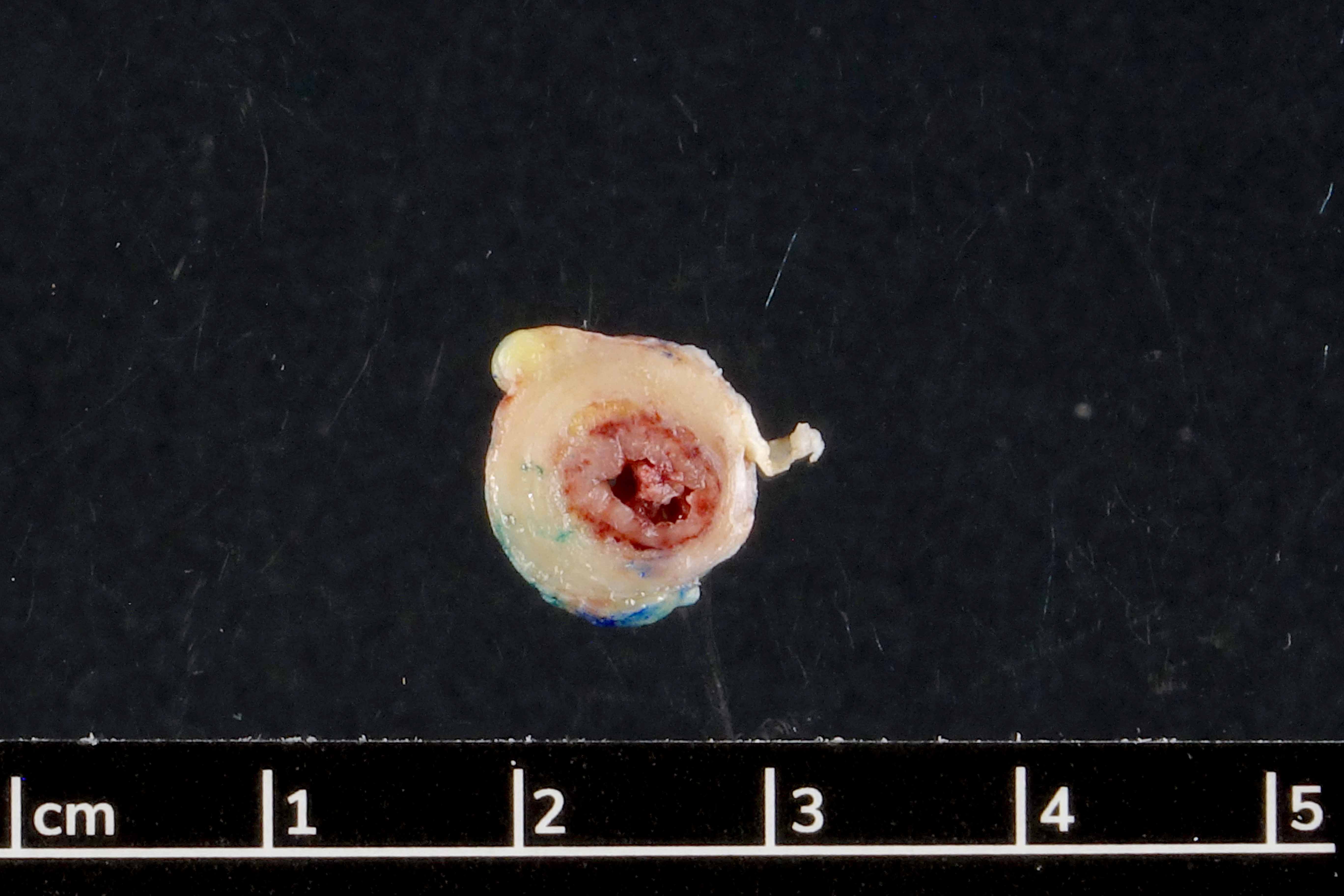 Pathology Outlines - Lymphoid hyperplasia