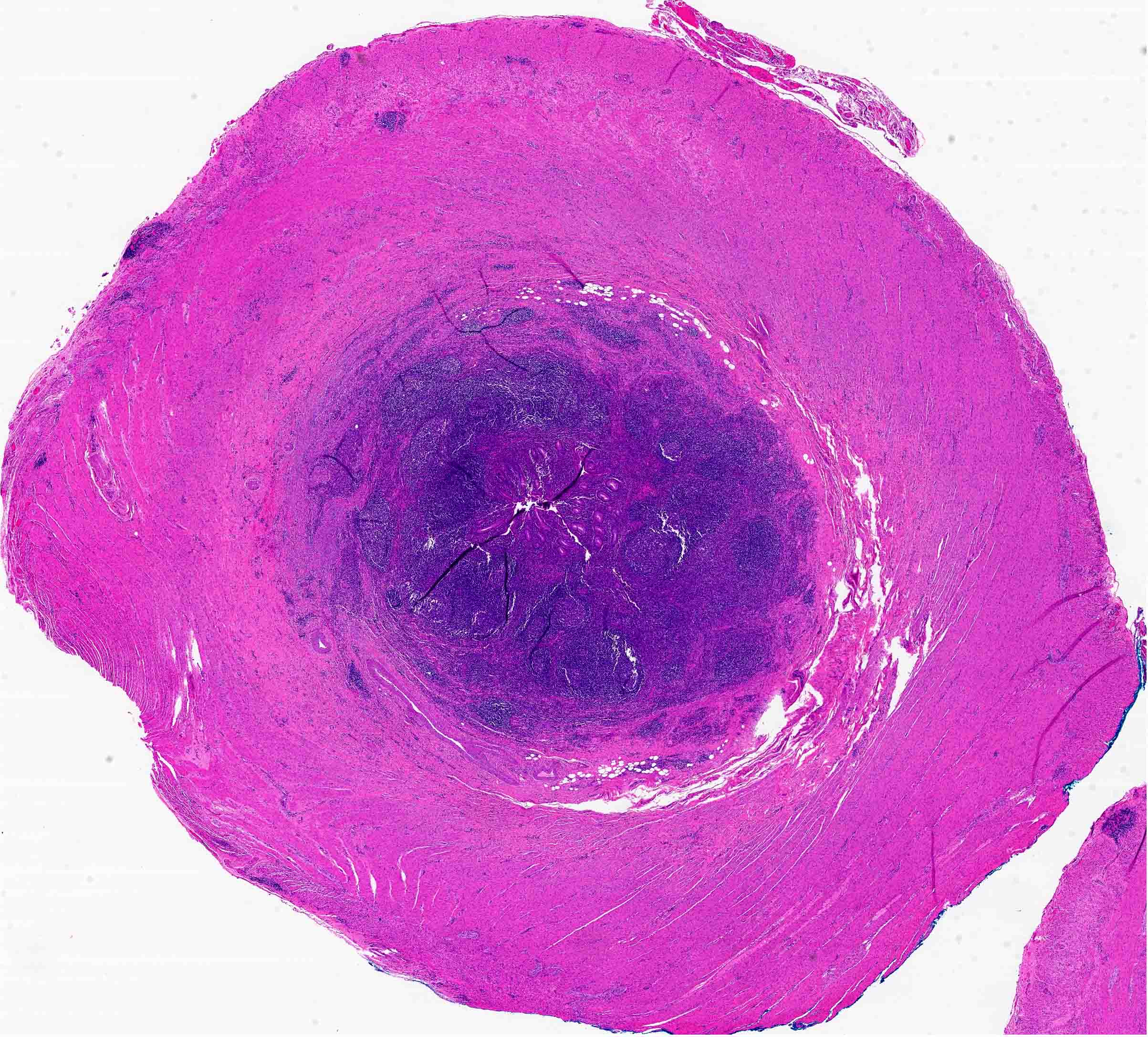 Pathology Outlines - Lymphoid hyperplasia