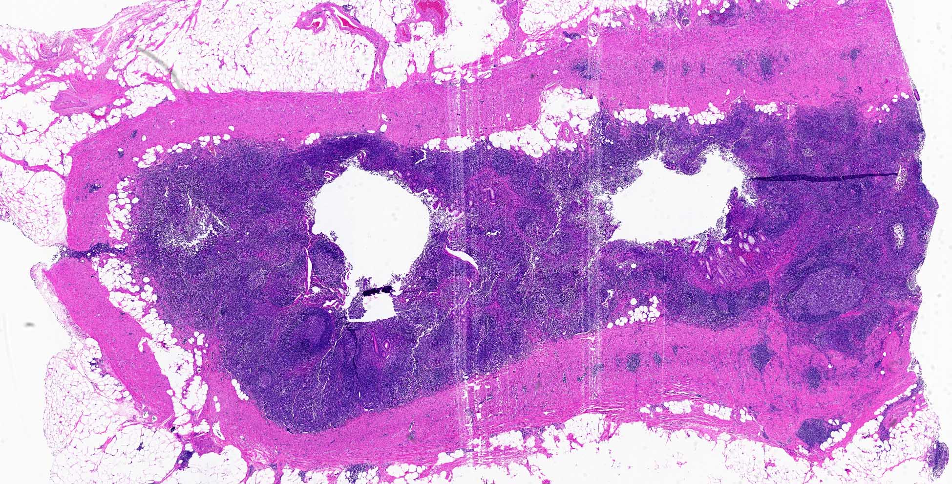 Pathology Outlines - Lymphoid hyperplasia