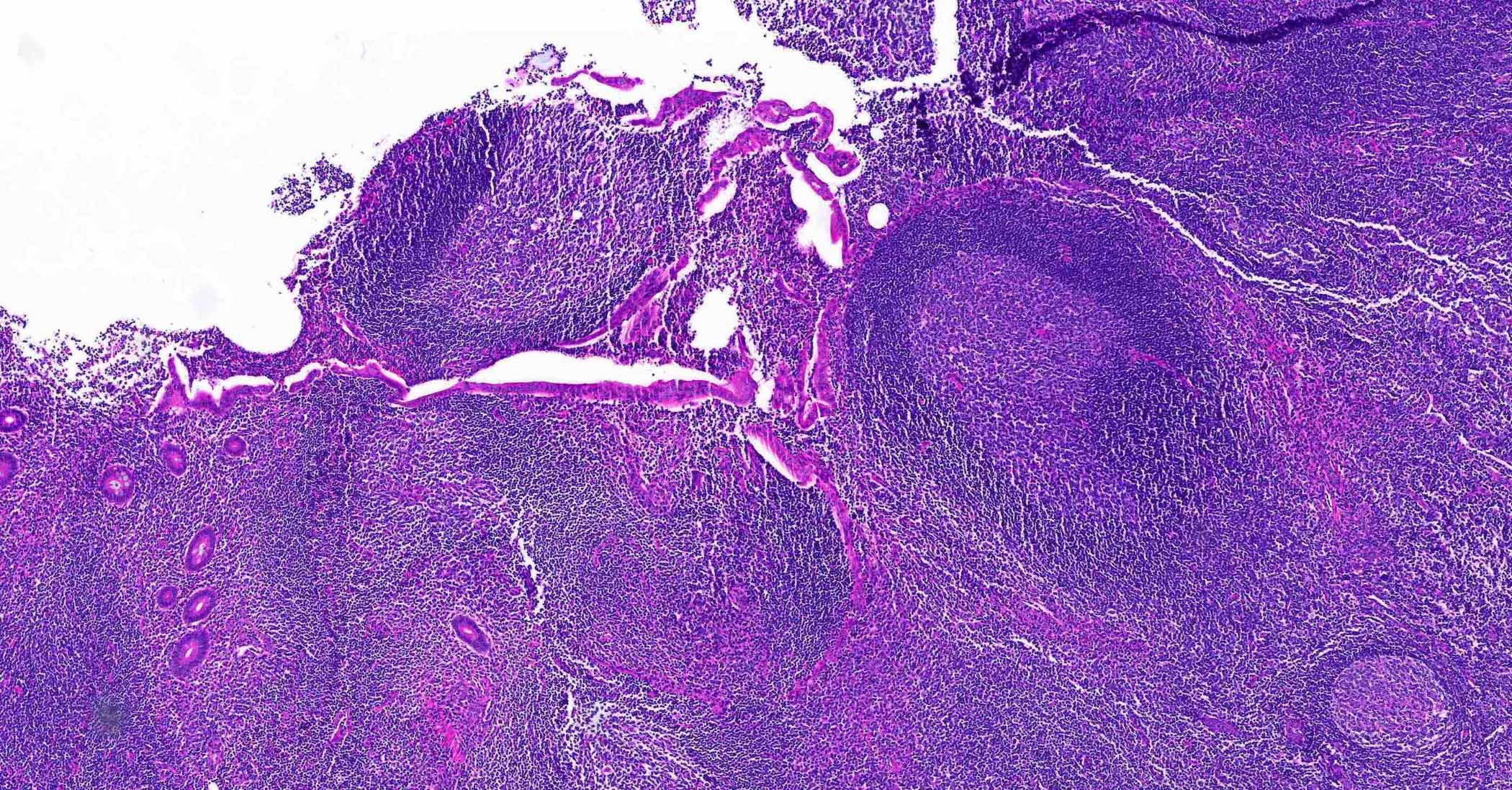 Pathology Outlines - Lymphoid hyperplasia