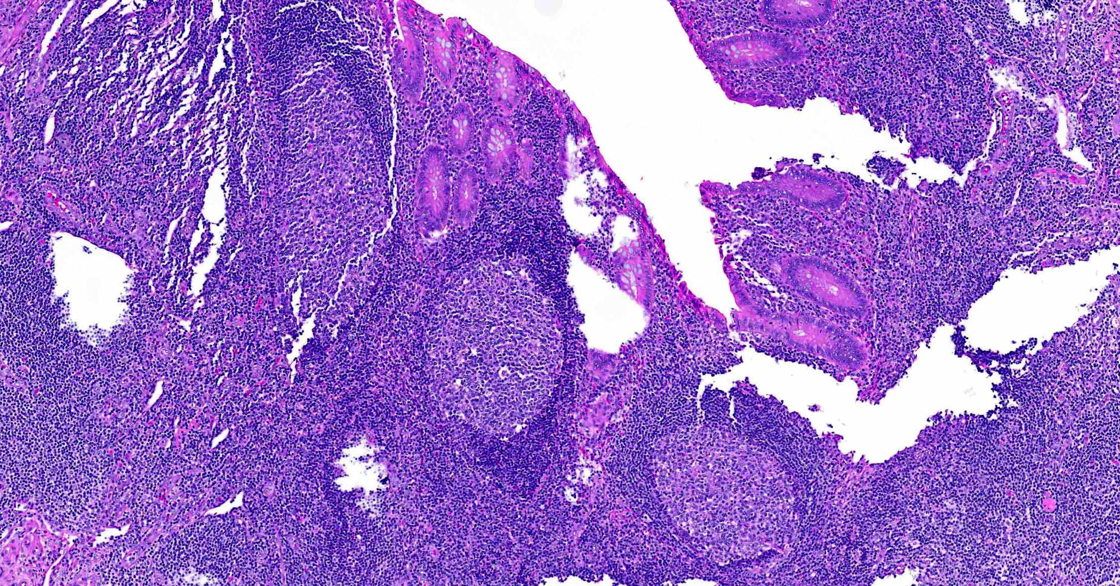 Pathology Outlines - Lymphoid hyperplasia