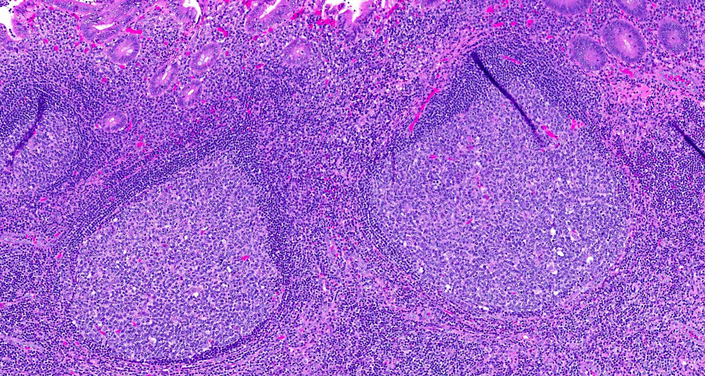 Pathology Outlines - Lymphoid hyperplasia