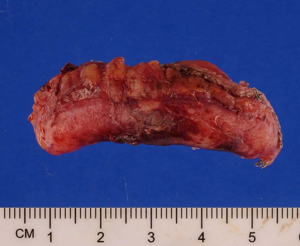 Pathology Outlines - Xanthogranulomatous inflammation