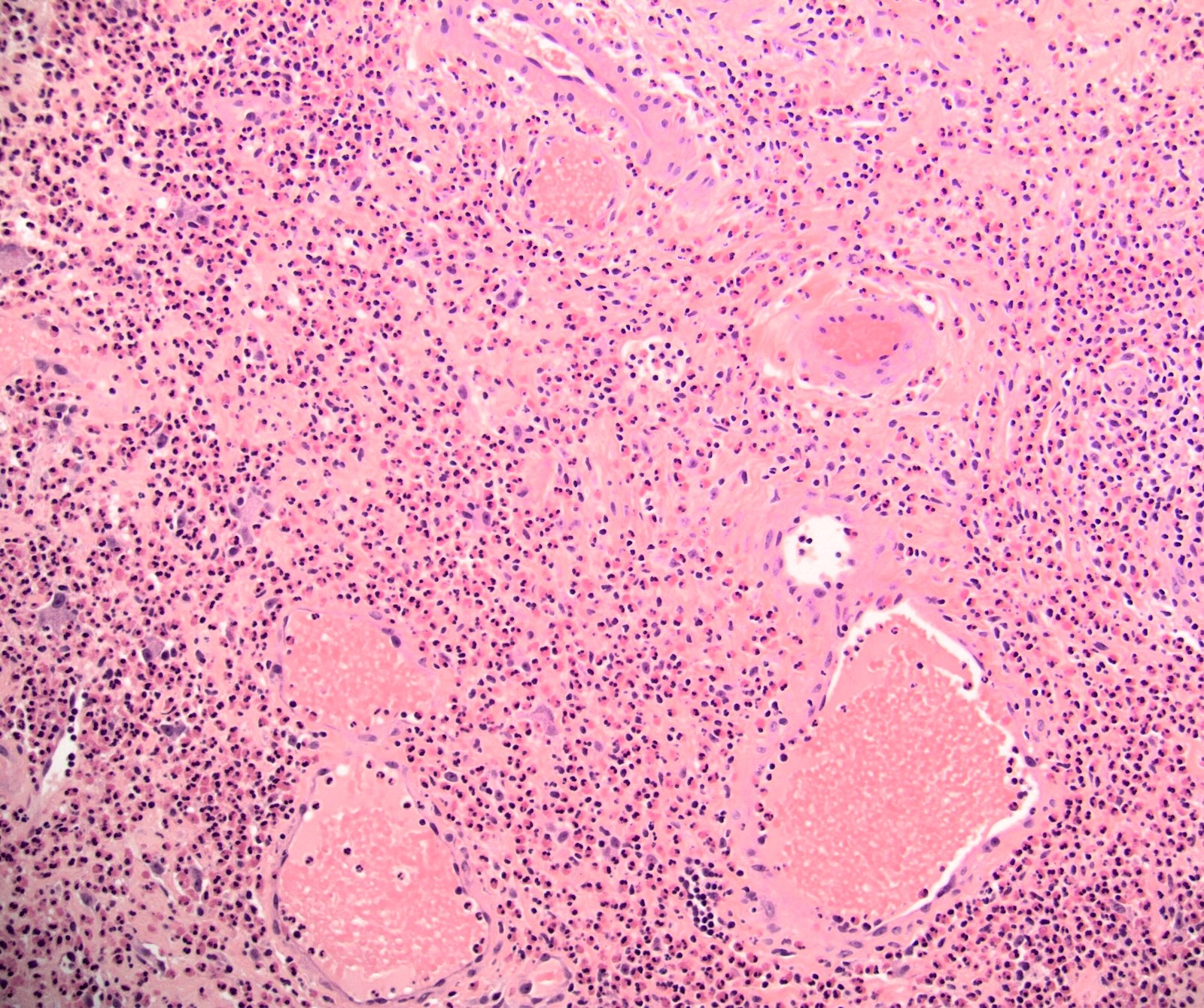 Pathology Outlines - Eosinophilic cystitis