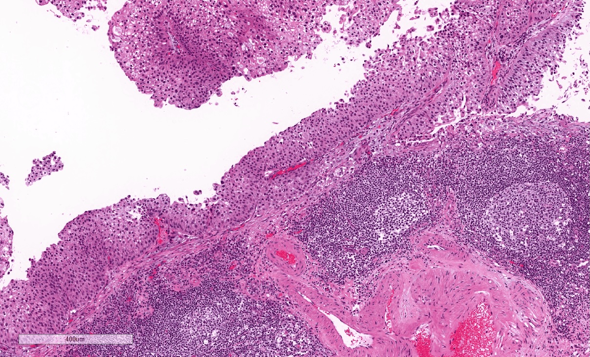 Pathology Outlines - Follicular cystitis