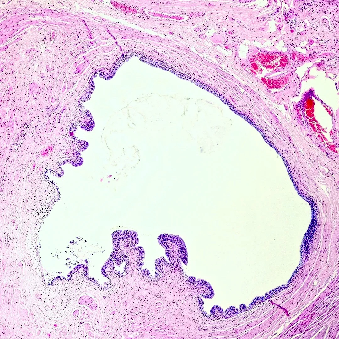Pathology Outlines - Urachus