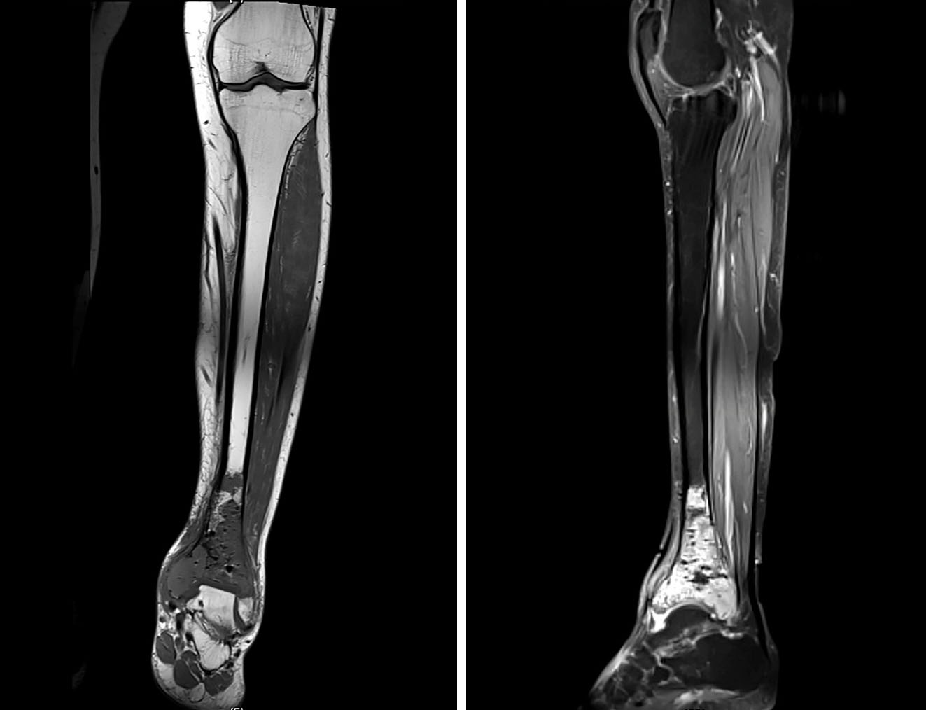 Pathology Outlines - Low grade (central) osteosarcoma