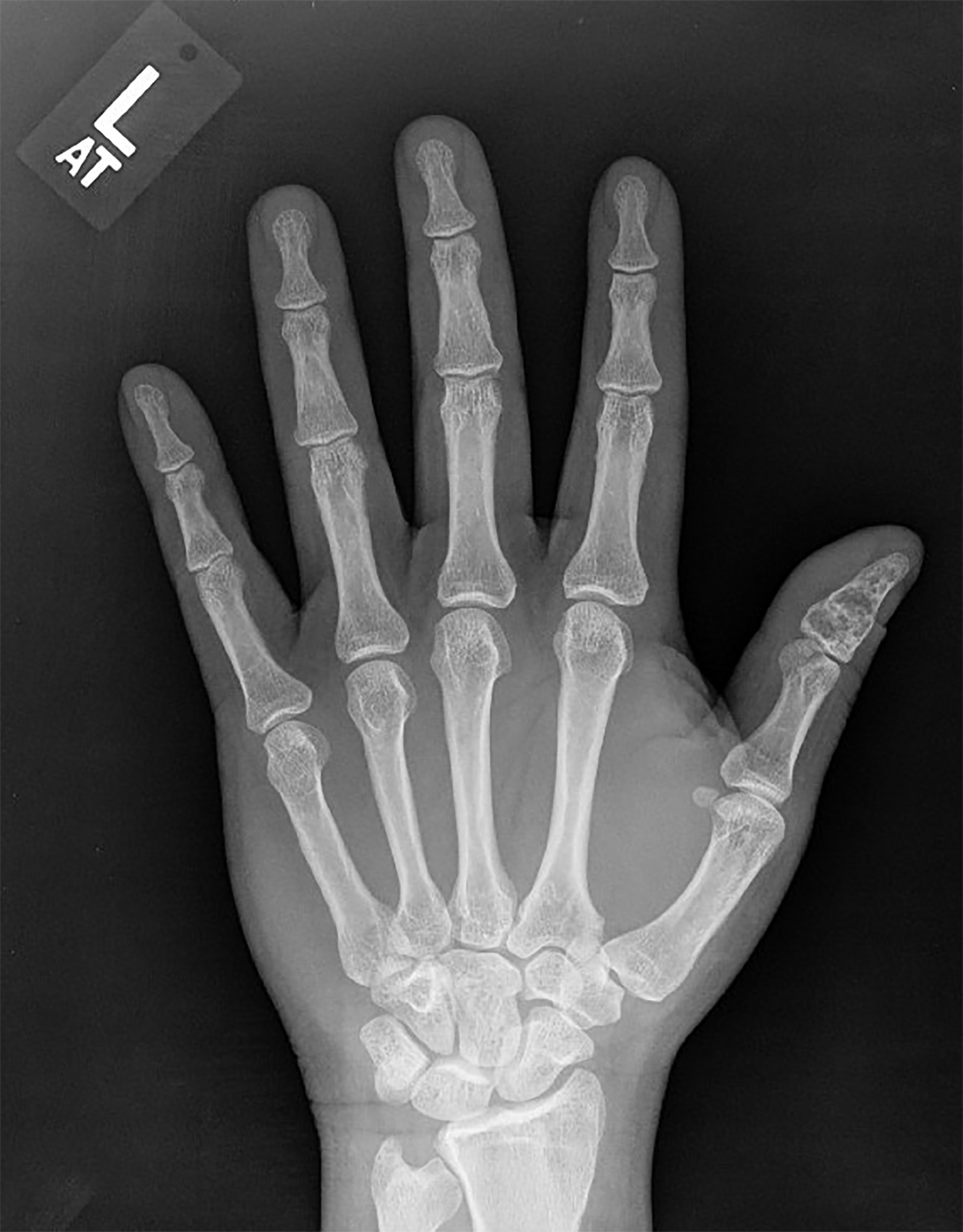 Pathology Outlines - Enchondroma