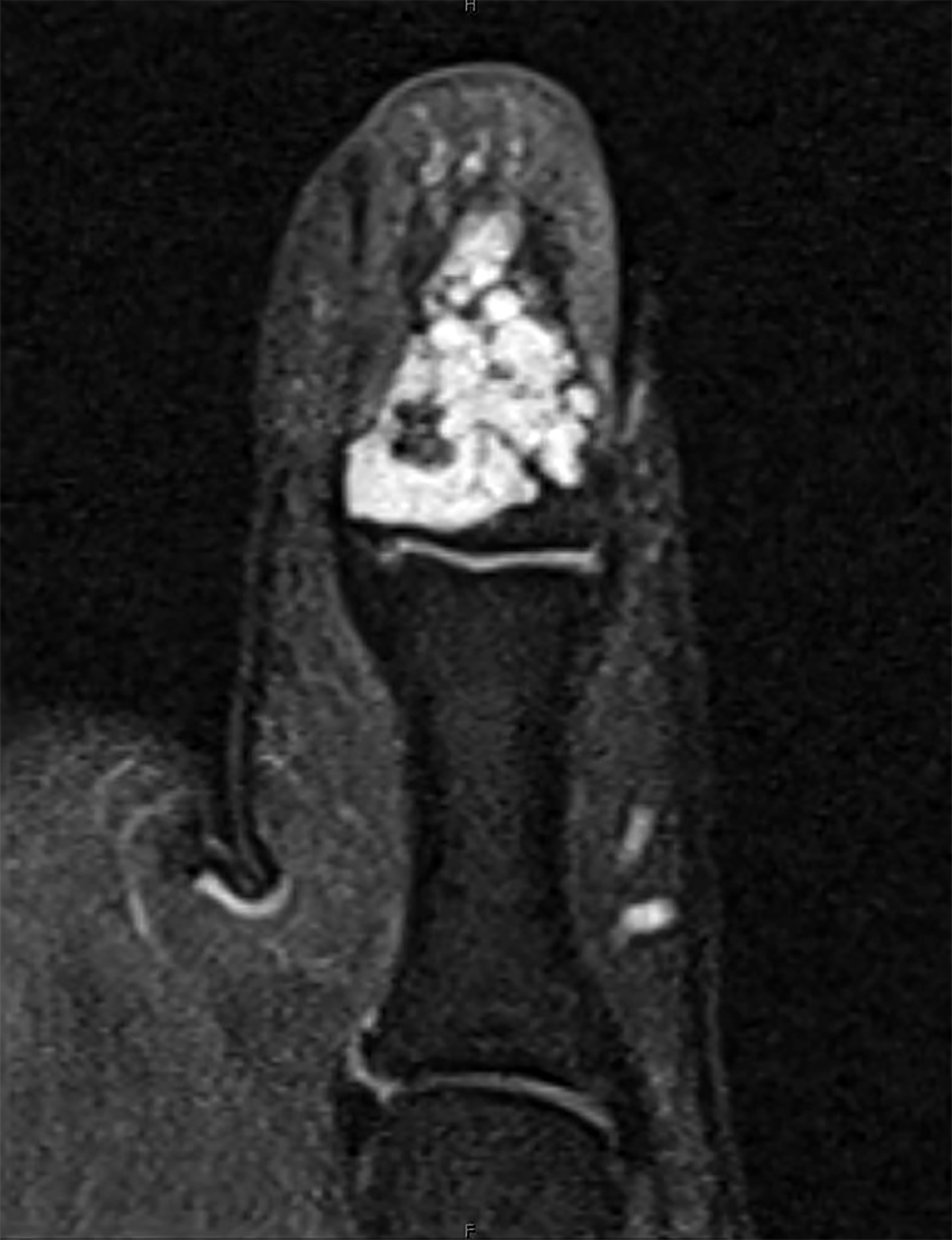 Multiple Enchondromatosis Histology